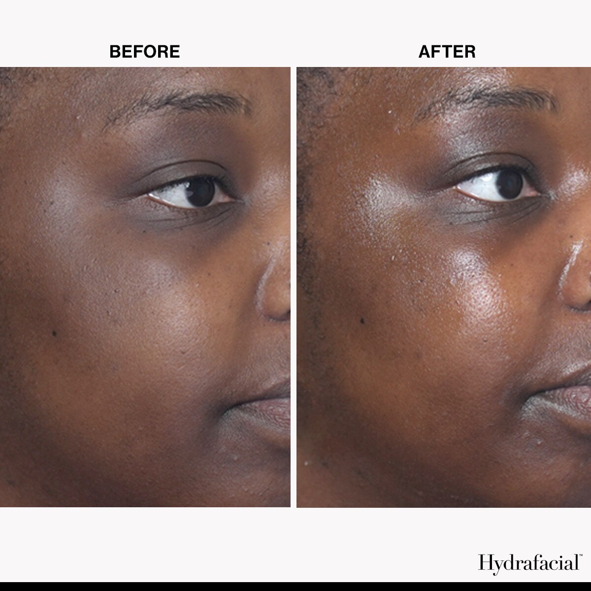 HYDRAFACIAL | Hydralock HA Booster (6/pack)